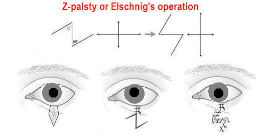 Medicine Decoded: Eponyms about Elschnig in Ophthalmology